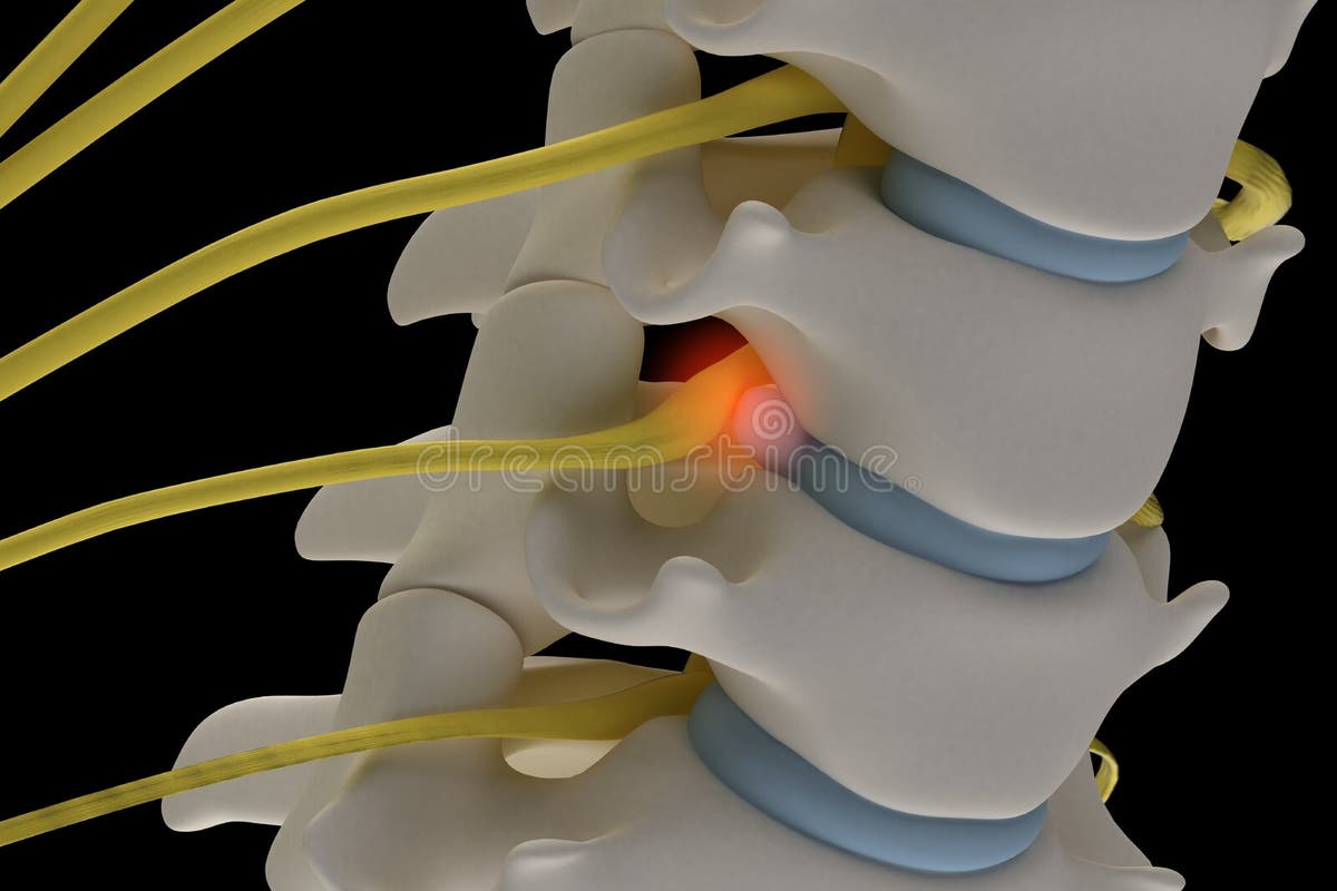 Nerve Root Stock Illustrations – 1,261 Nerve Root Stock Illustrations ...