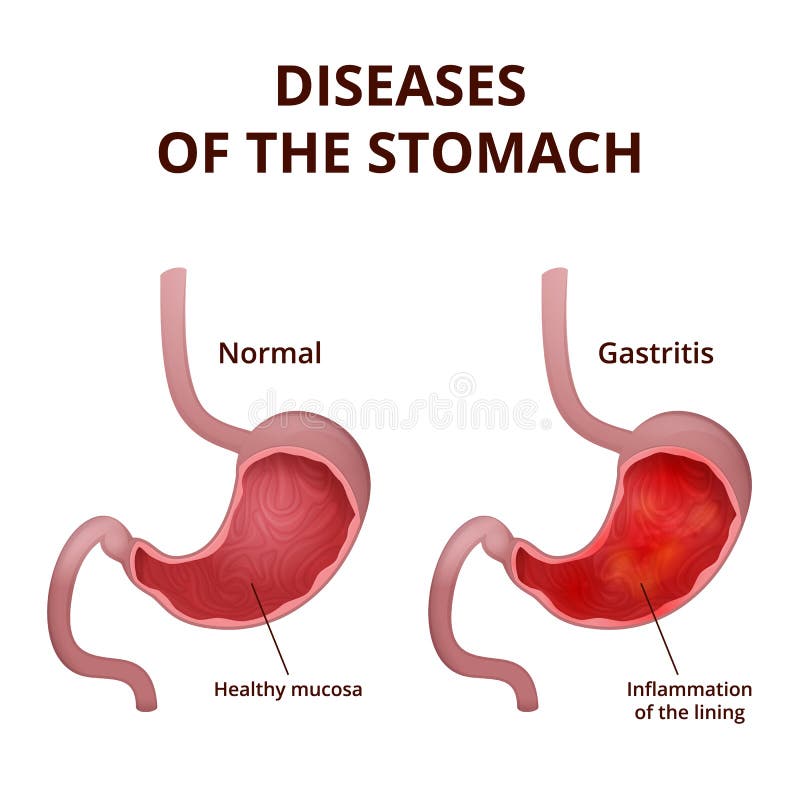 Anatomie Van De Menselijke Maag Vector Illustratie - Illustration of ...