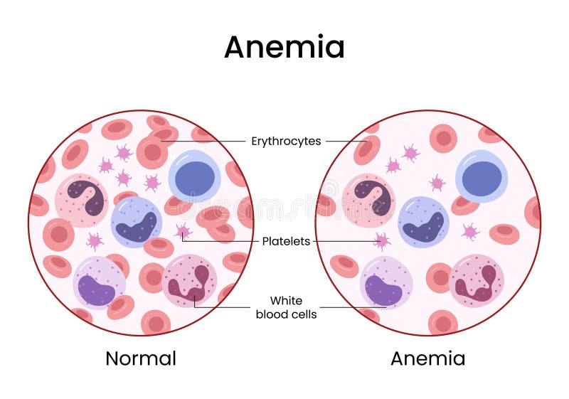 Vector Illustration of the Difference of Number of Healthy Red Blood ...
