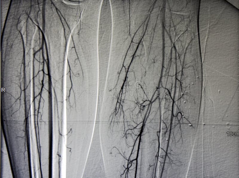 Angiogram of Leg Vessels, Both Calf Stock Image - Image of life, study ...