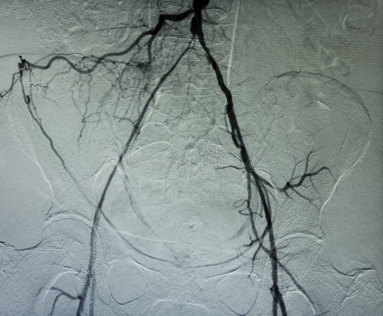 Angiogram of Pelvic Vessels Stock Image - Image of radiography, health ...