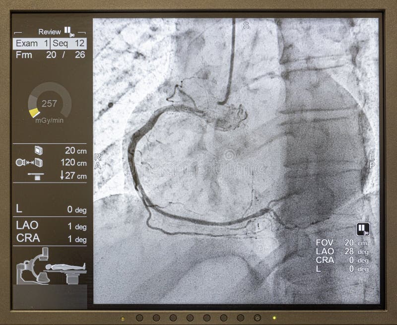 Angiogram Sequence Working Clockwise Using X-rays with a Contrast Agent ...