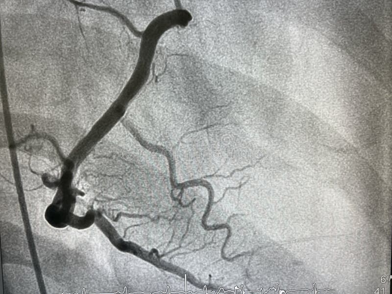 Angiograma coronario imagen de archivo. Imagen de medicina - 270927017