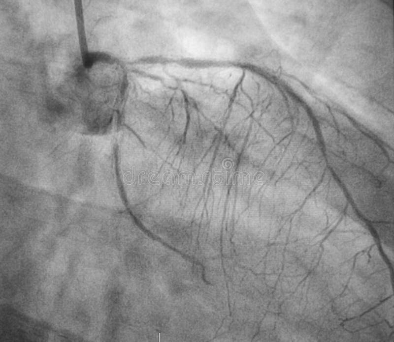 Angiographie Stock Illustrations, Vecteurs, & Clipart – (515 Stock ...