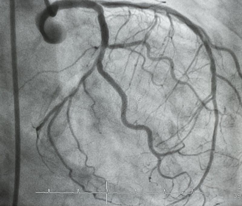 Angiographie Coronarienne. Image De Rayons X. Photo stock - Image du ...