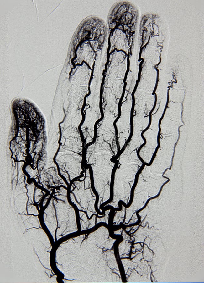 Angiographie De La Main, Artériographie Image stock - Image du malade ...