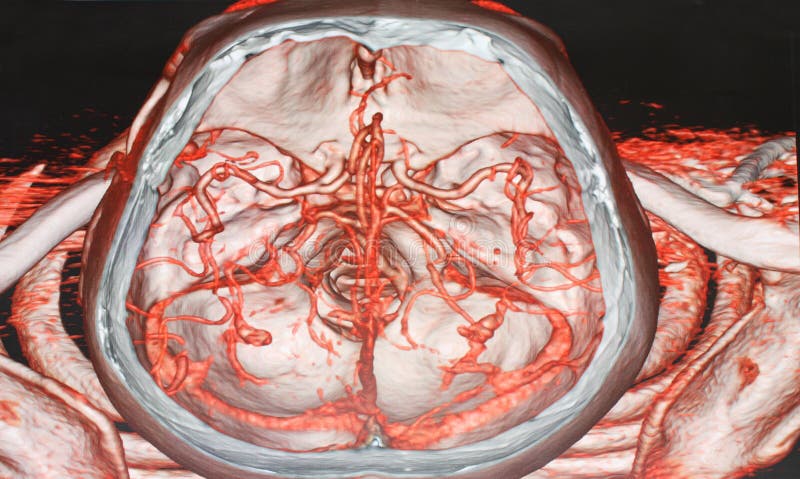 Angiography CT stock image. Image of skull, head, computerized - 49188447
