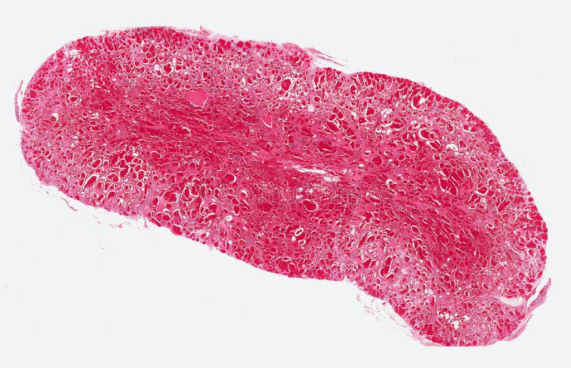 Angioma da pele imagem de stock. Imagem de capilar, benigno - 29278597