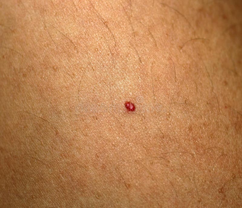 Angioma Rode Mol Op Het Lichaam Moedervlek Op Huid Stock Foto - Image ...