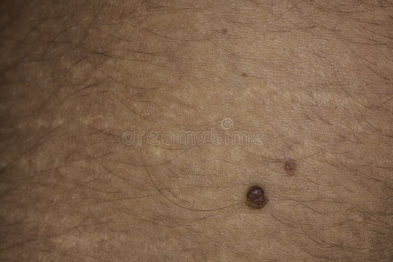 Angioma En La Piel Topos Rojos En El Cuerpo Muchos Lunares Imagen de ...