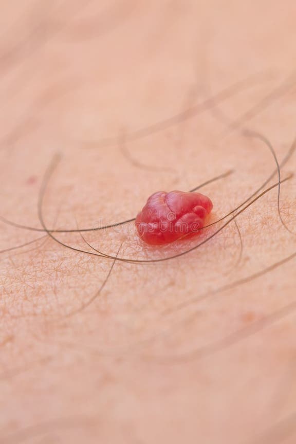 Angioma senil imagem de stock. Imagem de extremo, médico - 25491699