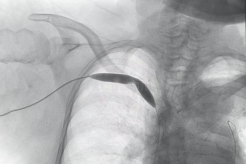 Angioplasty, Balloon Angioplasty and Percutaneous Transluminal ...