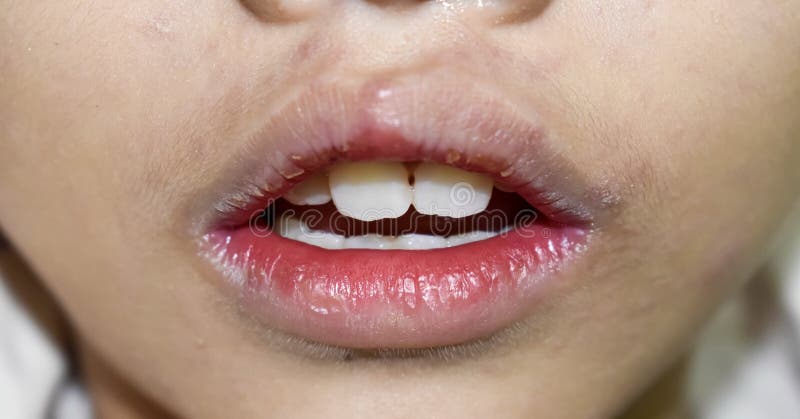 Angular Stomatitis or Angular Cheilitis or Perleche in Asian Little Boy ...