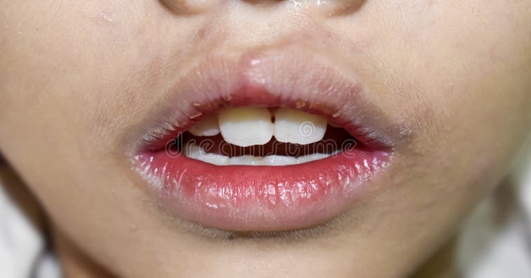 Asian Angular Cheilitis Stock Photos - Free & Royalty-Free Stock Photos ...