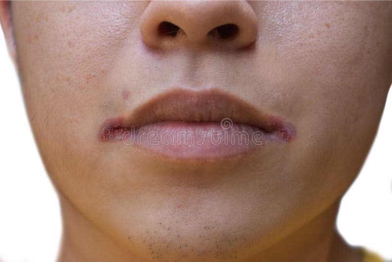 Angular Cheilitis Male