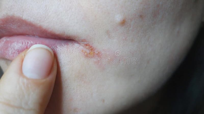 Angulus Infectiosus. Inflammation of Corner Mouth. Lack of Vitamins ...