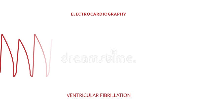 ECG of a Patient with Ventricular Fibrillation. 3d Animation Render ...