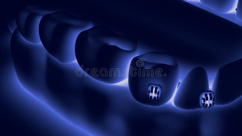 Animation dental brackets stock video. Video of cosmetic - 101454829