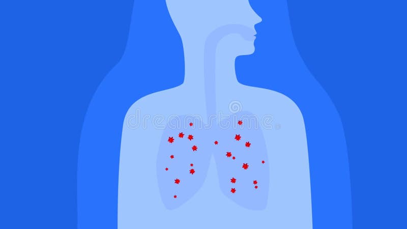 Animation of Lung Disease, or Respiratory System, Coronavirus. Bacteria ...