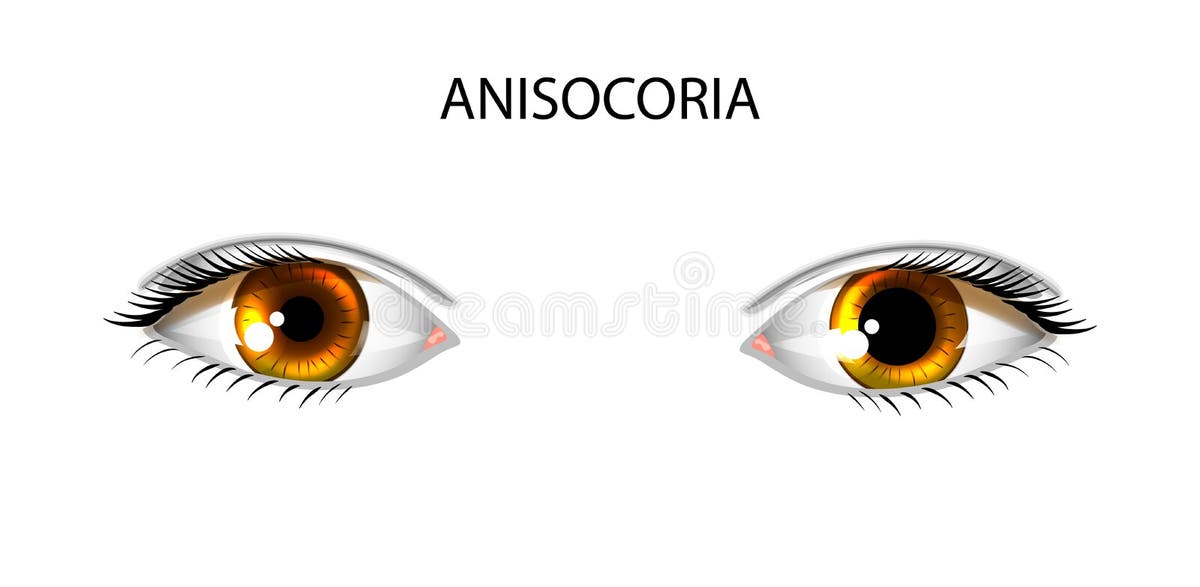 Anisocoria Stock Illustrations – 16 Anisocoria Stock Illustrations ...