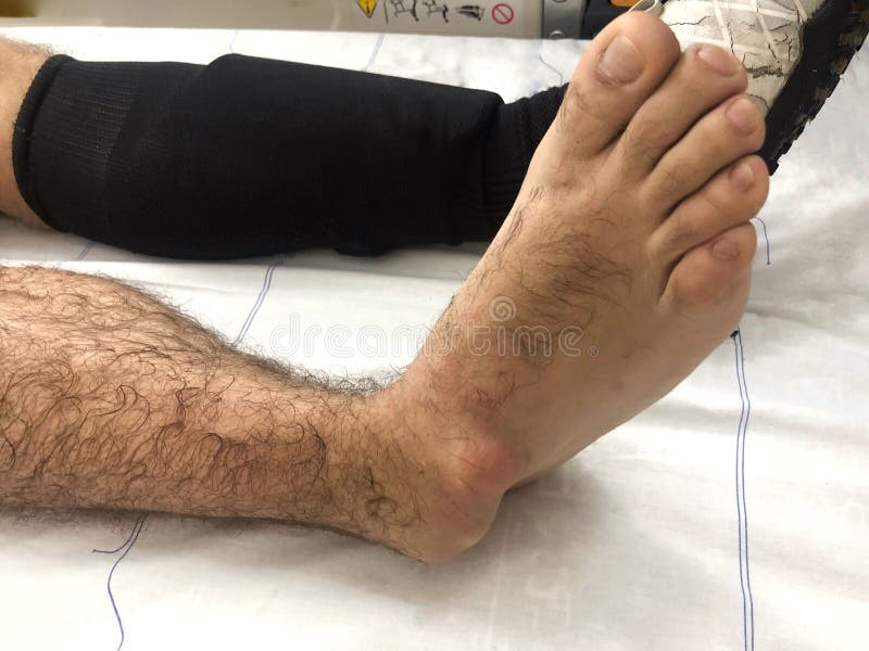 Ankle Dislocation while Doing Sports. Stock Image - Image of ...
