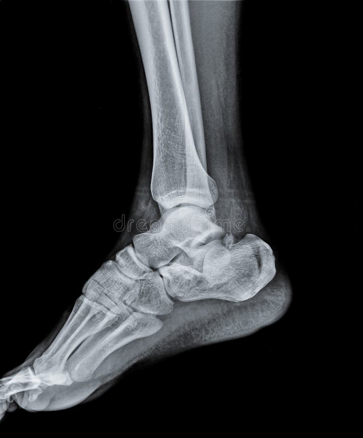 X Ray of Knee Joint with Femur, Tibia and Fractured Fibula Bone. Stock ...