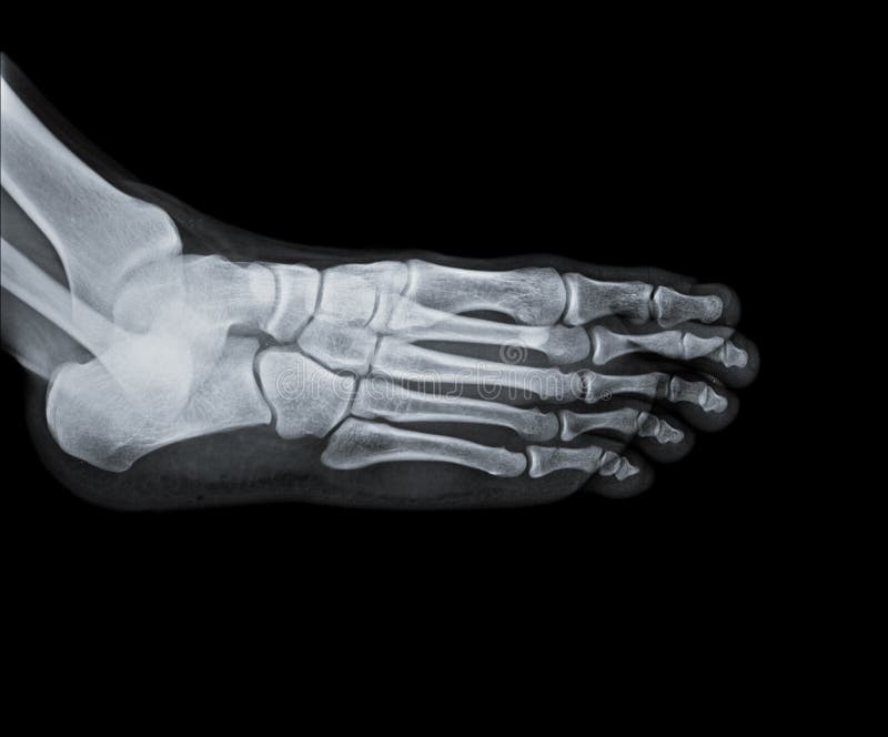 Ankle Joint with Foot and Tibia Stock Photo - Image of pain, tibia ...