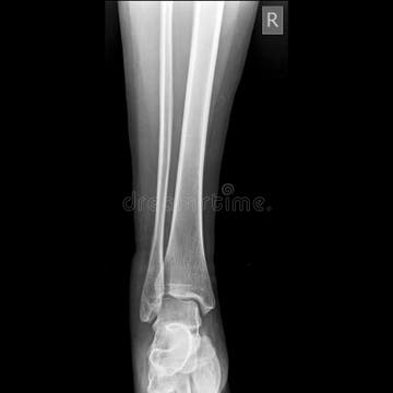 Ankle Joint and Lower Leg X-ray Image AP View Stock Image - Image of ...