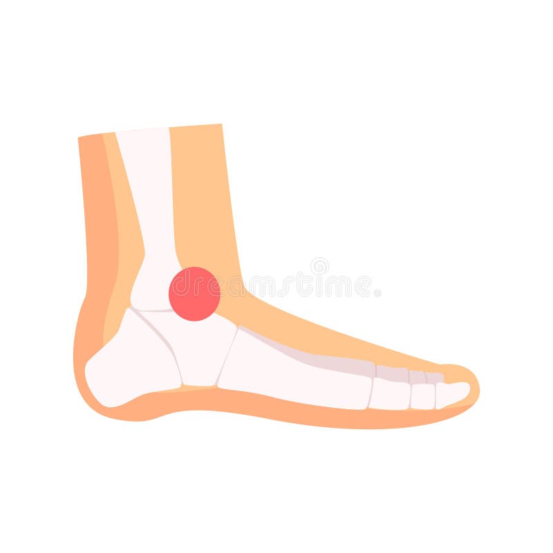Painful ankle illustration stock illustration. Illustration of ...