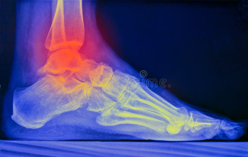 Ankle Pain Illustration, X Ray Stock Photo - Image of doctor, ankle ...