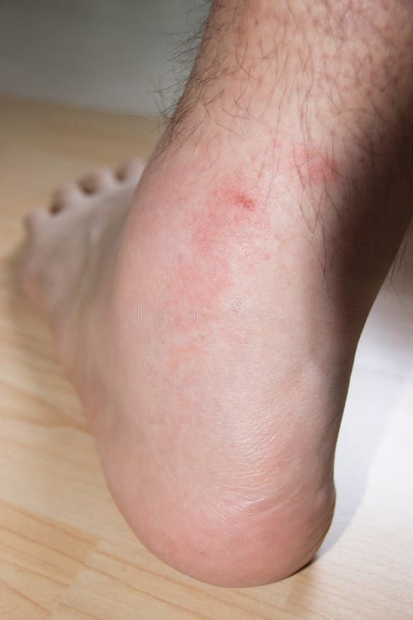 Elephant Leg Disease