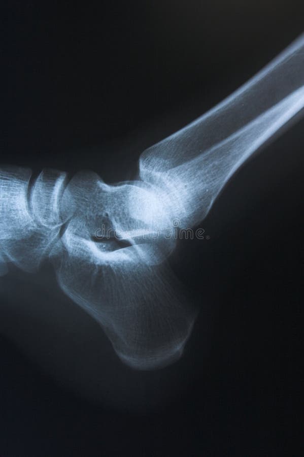 Ankle x-ray stock photo. Image of film, fracture, ankle - 989848