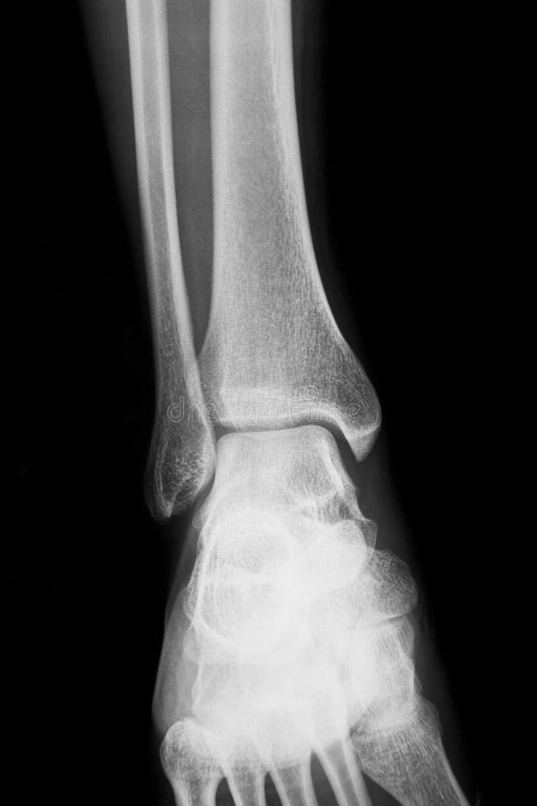 478 Bones Ankle Anatomy Stock Photos - Free & Royalty-Free Stock Photos ...