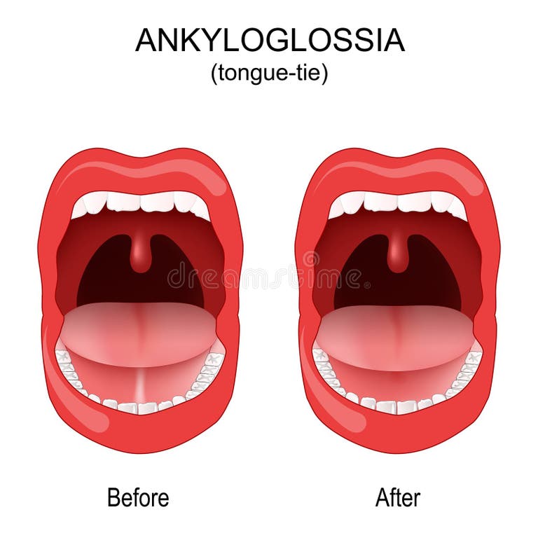 Lingual Frenulum Stock Illustrations 4 Lingual Frenulum Stock Illustrations Vectors And Clipart