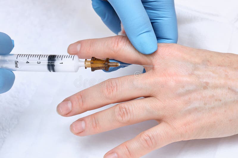 Anti-age Injection Therapy. Hand Rejuvenation. Stock Photo - Image of ...