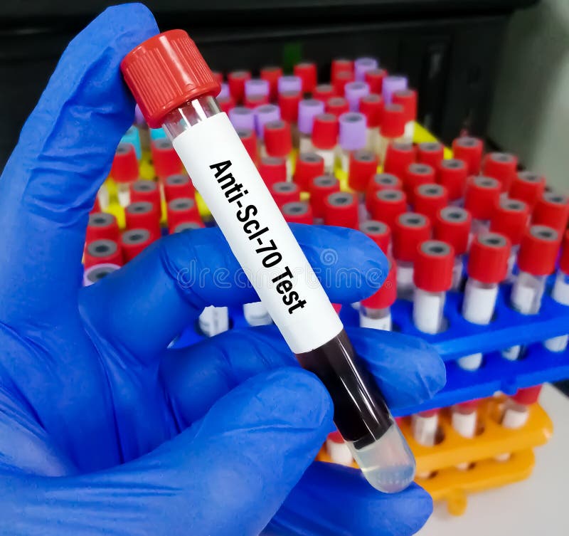 Anti–Scl-70 Antibody, Diagnosis of Scleroderma Stock Photo - Image of ...