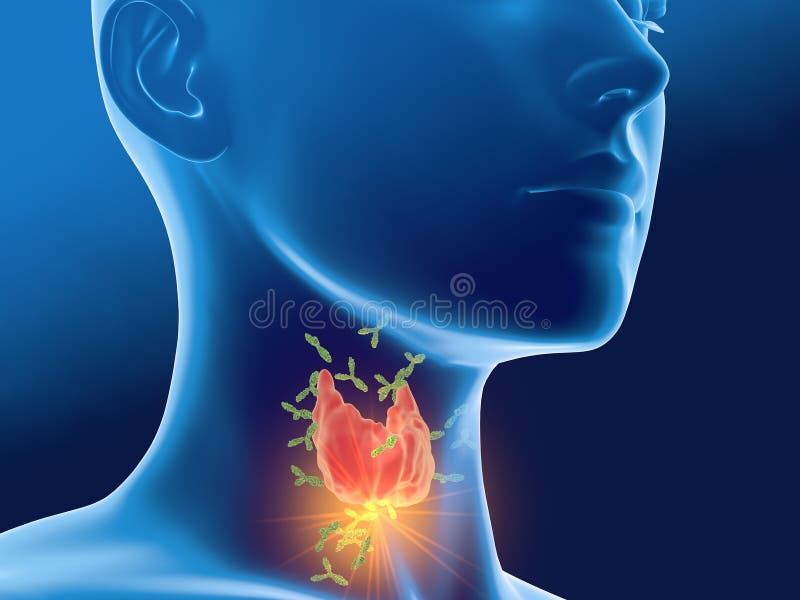 Anticuerpos Que Atacan La Glndula Tiroides De Una Mujer Tiroiditis