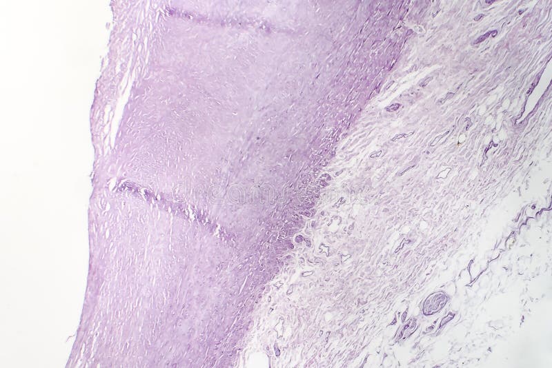 Aortic Atherosclerosis, Light Micrograph Stock Photo - Image of ...