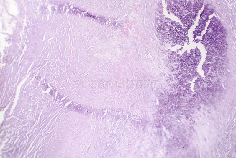 Aortic Atherosclerosis, Light Micrograph Stock Photo - Image of stain ...