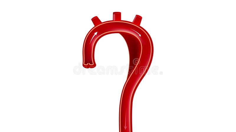 Aortic Dissection. Cross-section of Blood Vessel. Stock Footage - Video ...