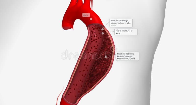Aortic Dissection is a Serious Cardiovascular Condition Characterized ...
