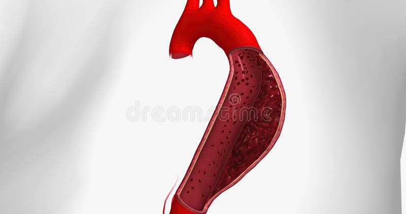 Aortic Dissection Stock Illustrations – 67 Aortic Dissection Stock ...