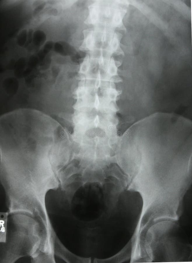 Psoas Sign X Ray