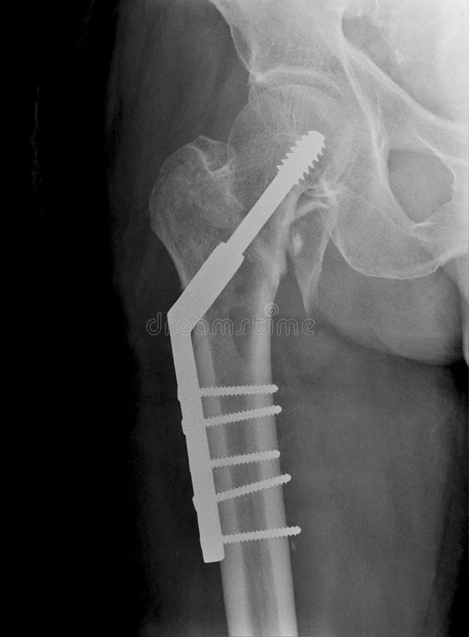 Gebroken Heup Röntgenfoto Heup, Gebroken