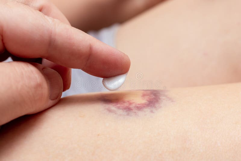 Aplicare Unguent Pe Hematom. Foarte Rare Stock Image - Imagine din uman ...