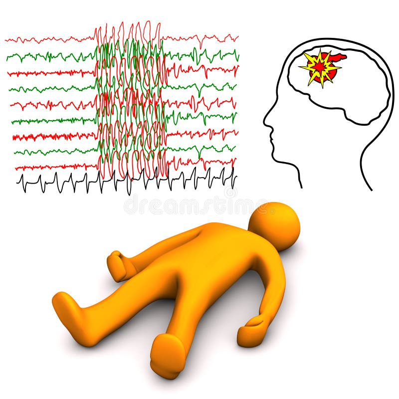 Apoplectic And Epileptic Stroke Stock Illustration Illustration Of Head Eppy 24860753