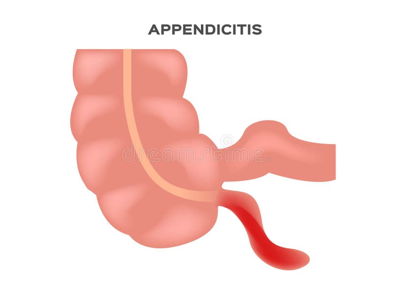 Appendicite illustration de vecteur. Illustration du abdominal - 83855653