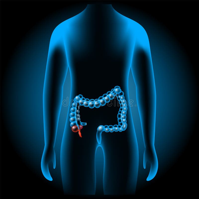 Appendicitis. Inflammation of the Appendix Stock Vector - Illustration ...