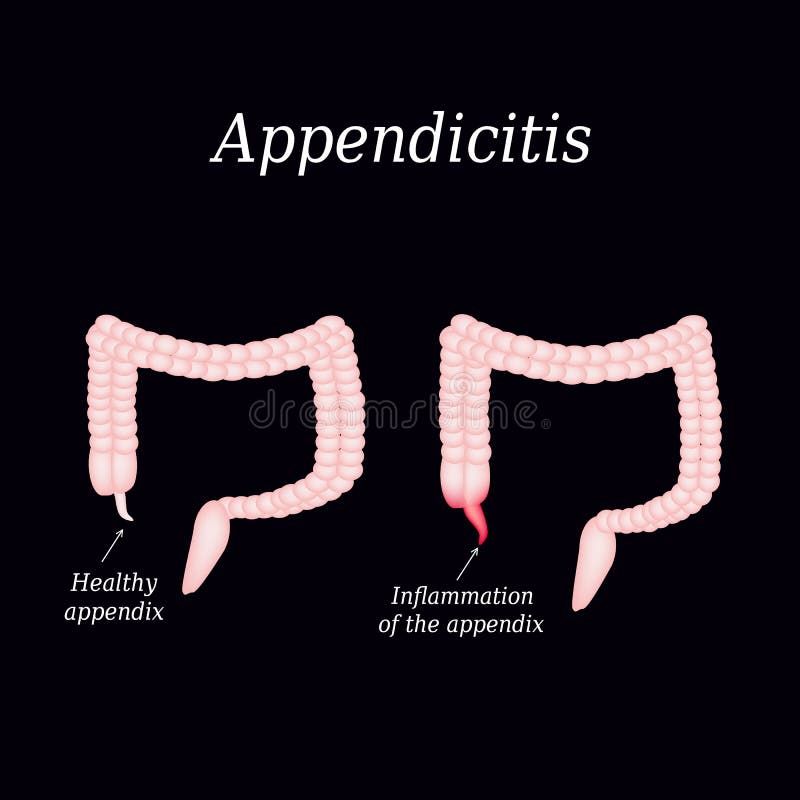 Appendicitis. Inflammation of the Appendix. Colon Stock Vector ...