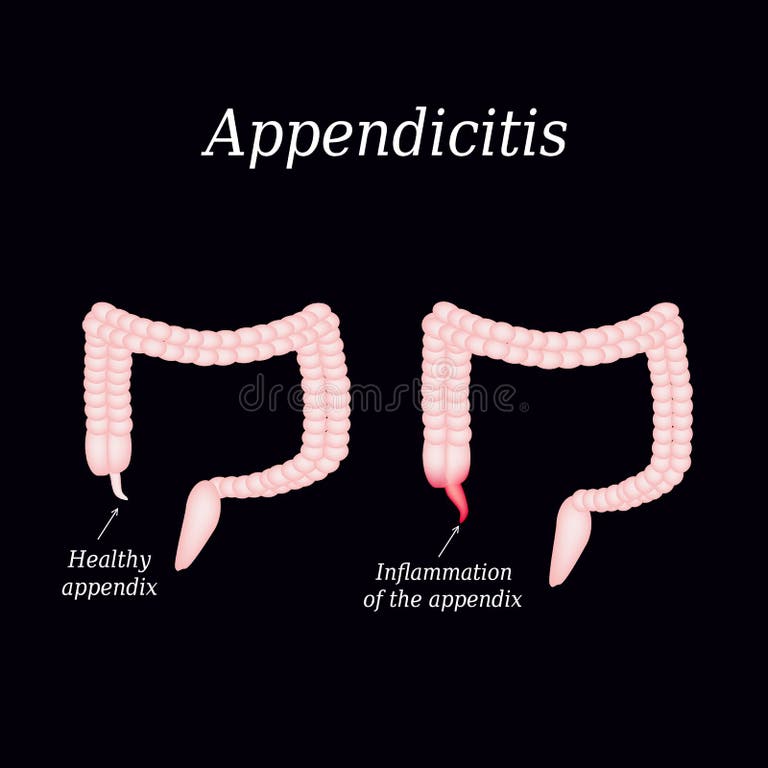 Appendicitis. Inflammation of the Appendix. Colon Stock Vector ...